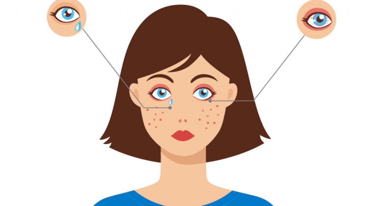 Como Curar La Alergia En Los Ojos Consejos Ojos