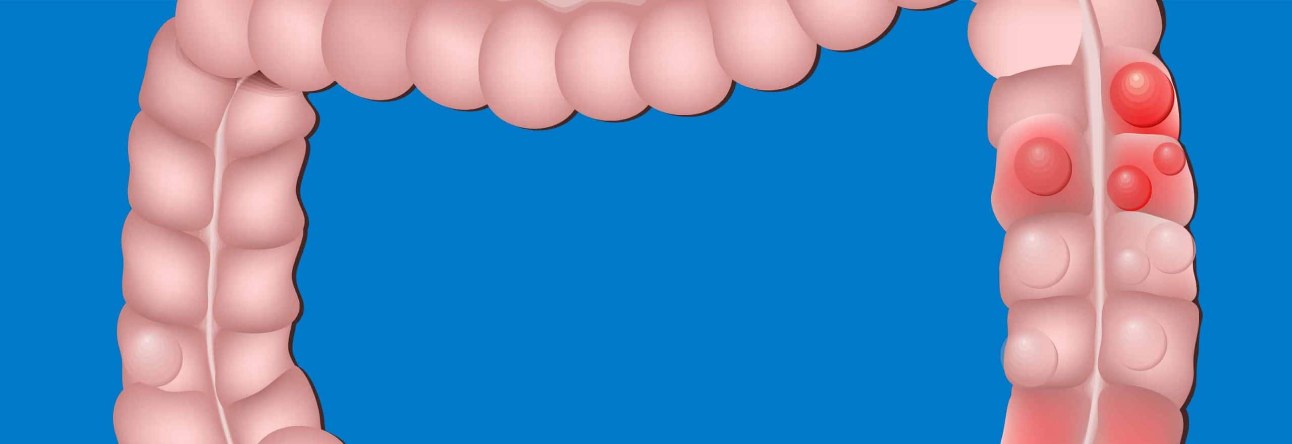 Qu Es La Diverticulitis Causas Sntomas Y Tratamientos