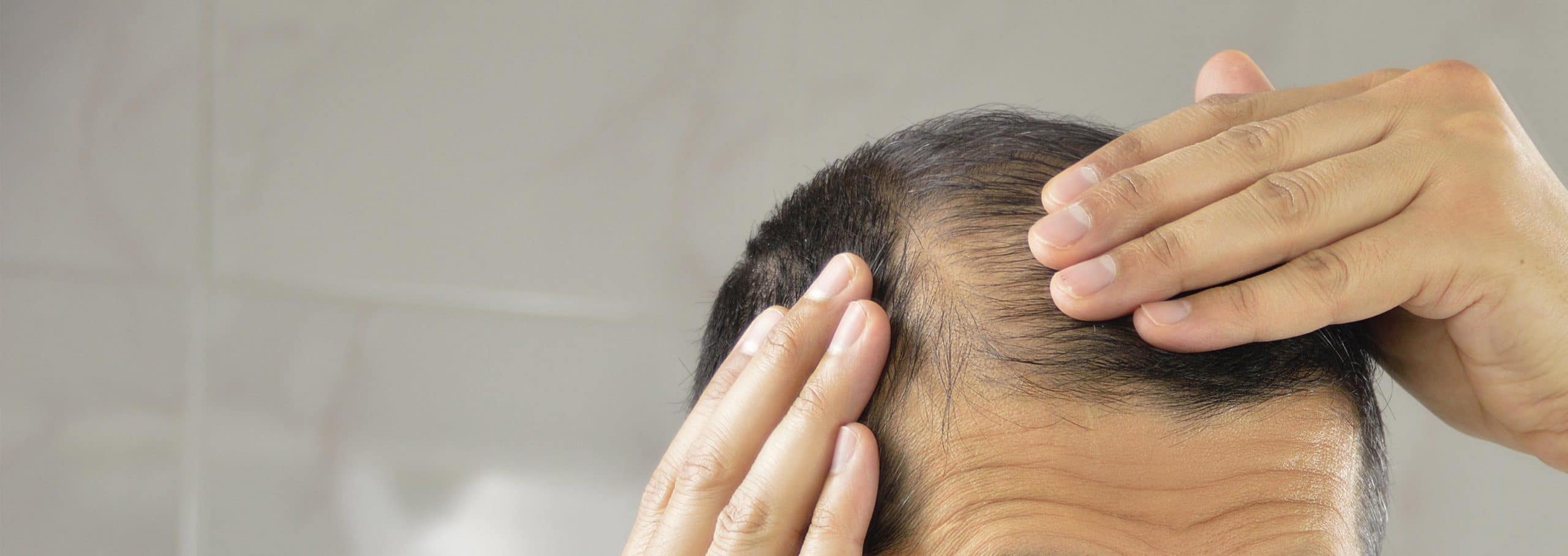 Caída de pelo: causas y soluciones • Portal de salud